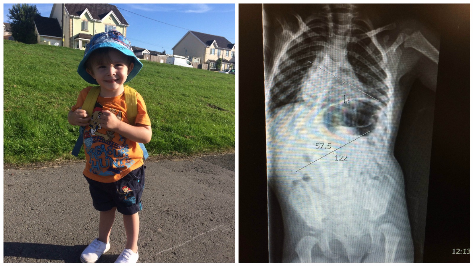 Mum's plea after 2-year-old son's crooked spine worsens | ITV News Wales
