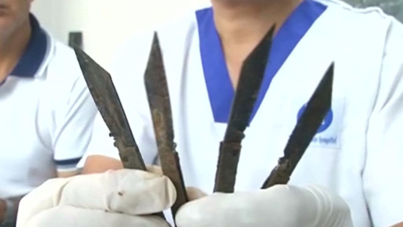 Man with 'urge' to eat metal has 40 knives removed from his stomach ...