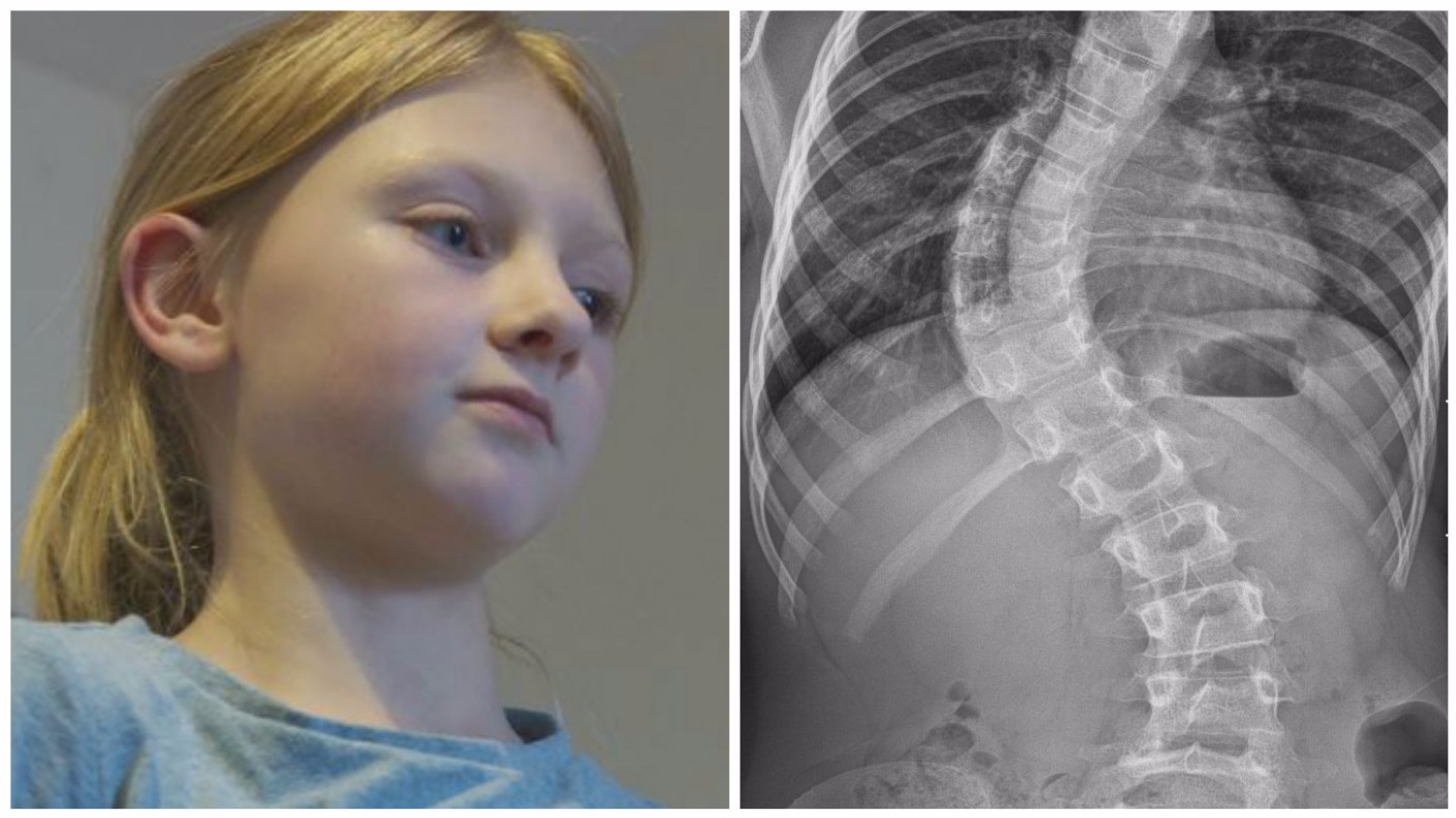 Young girl's race for operation in the USA to straighten her spine ...