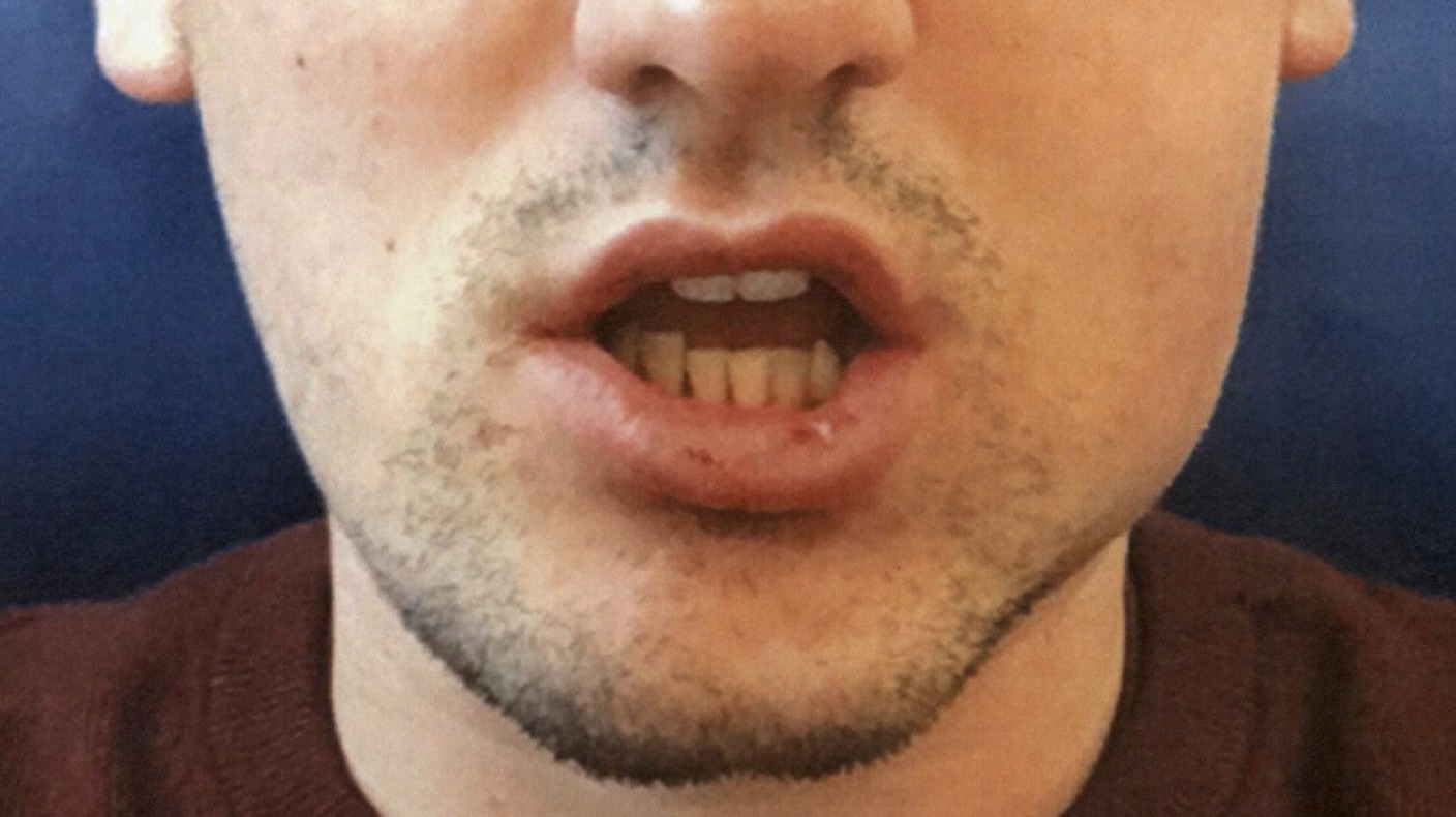 Man fitted with metal plate after jaw shattering assault in Newcastle ...