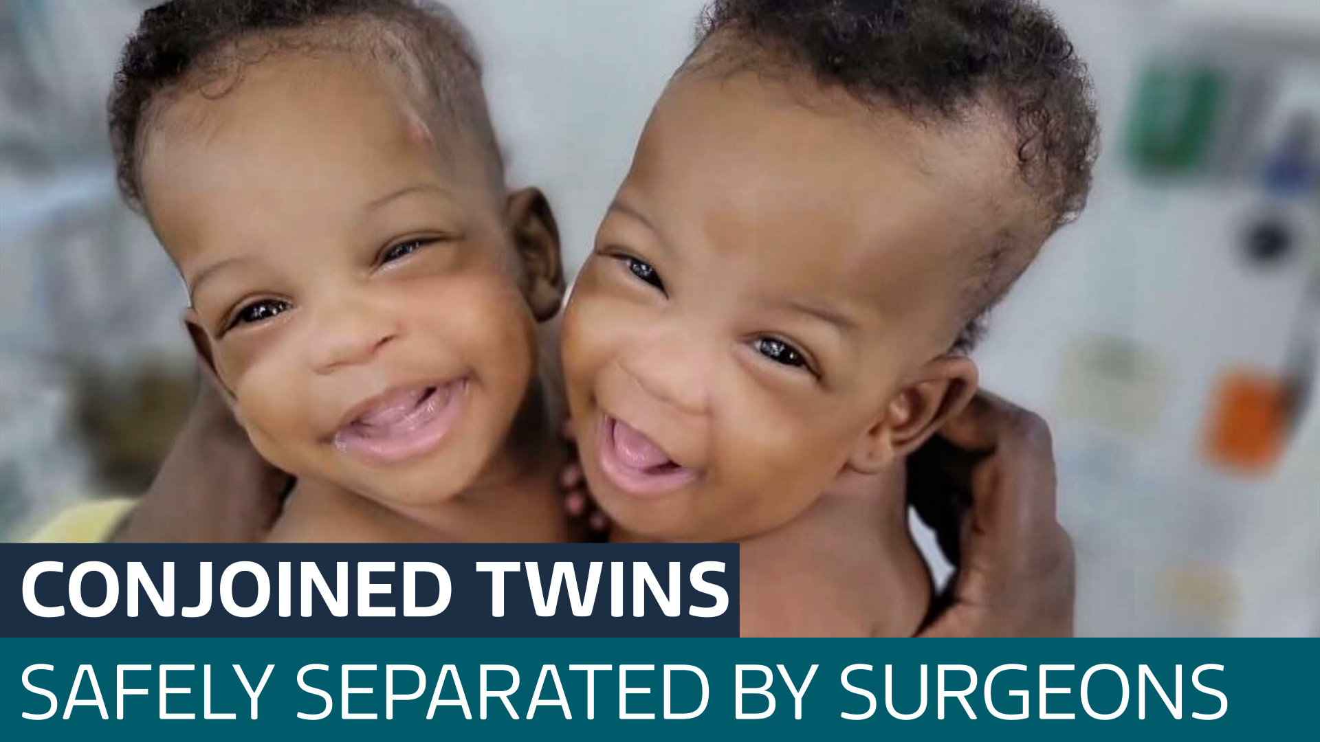 Conjoined twins safely separated by surgeons - Latest From ITV News