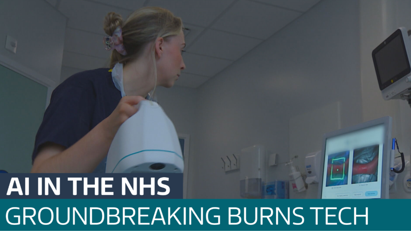 World first technology predicts healing timescale for burns patients ...