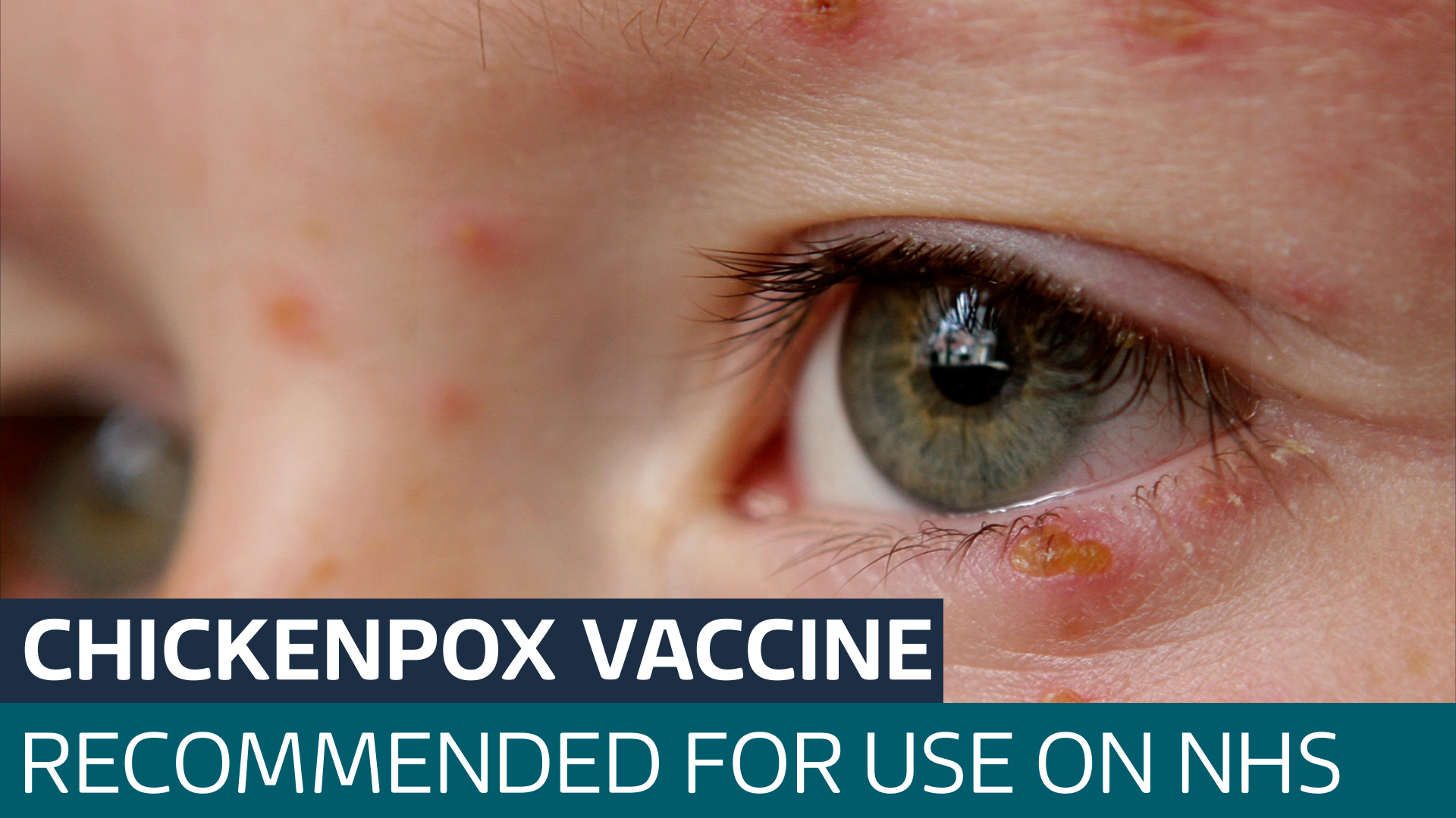 Childhood chickenpox vaccine recommended for use on the NHS - Latest ...