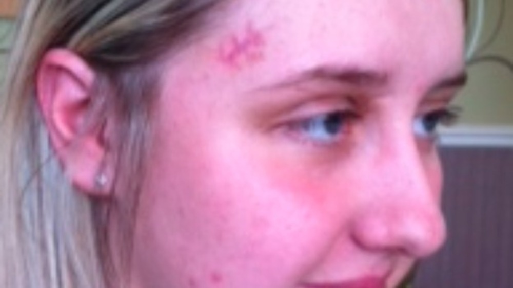 Nurse slashed across face | ITV News Central