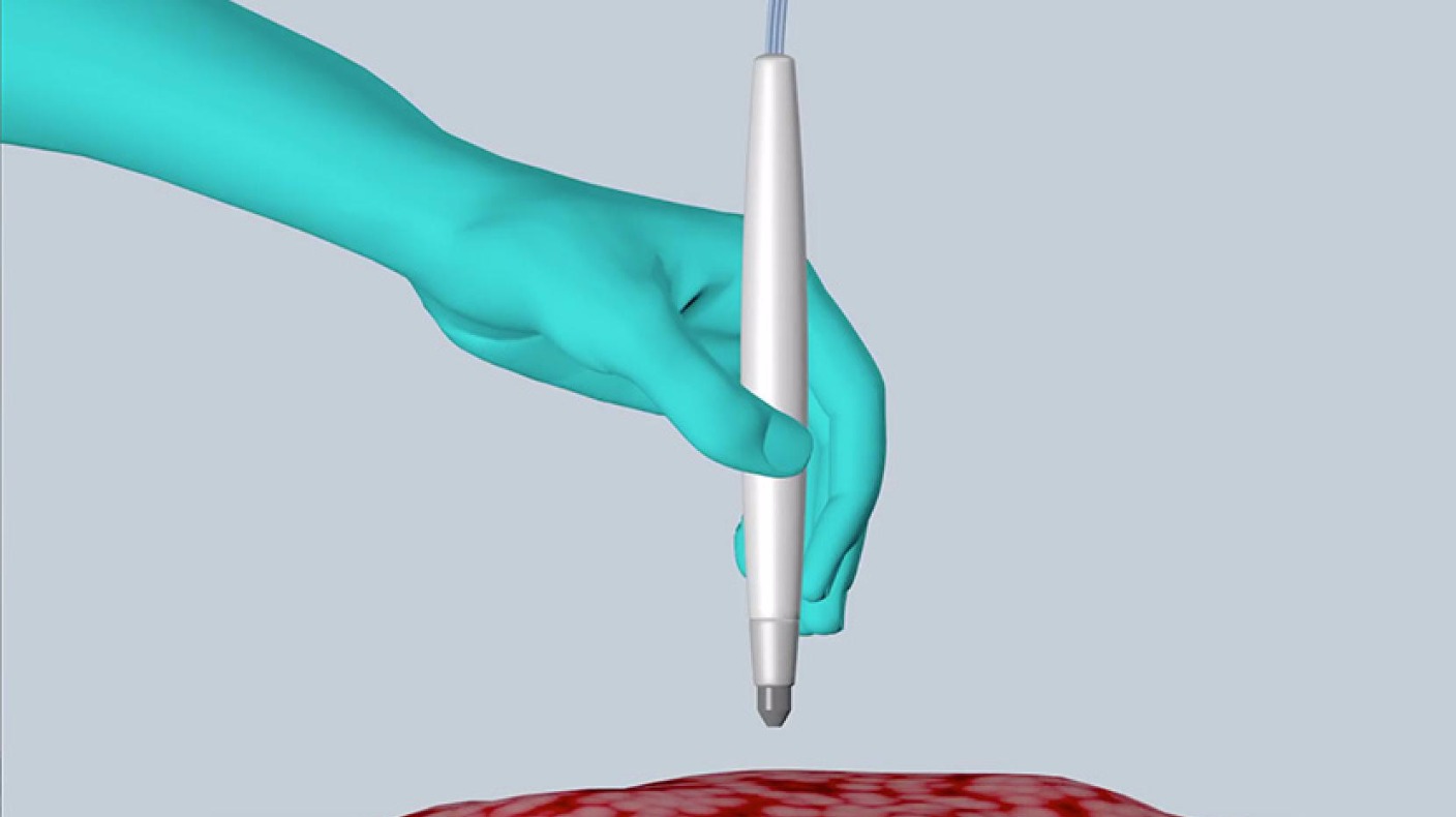 Scientists create 'pen' that can detect cancer in ten seconds | ITV News