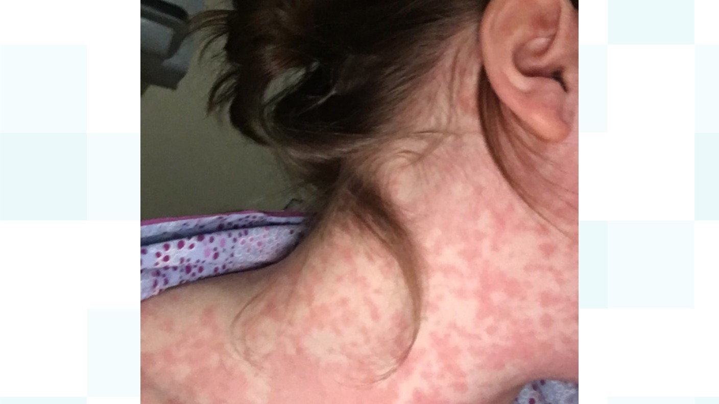 Woman who contracted a rare form of measles speaks about her experience ...
