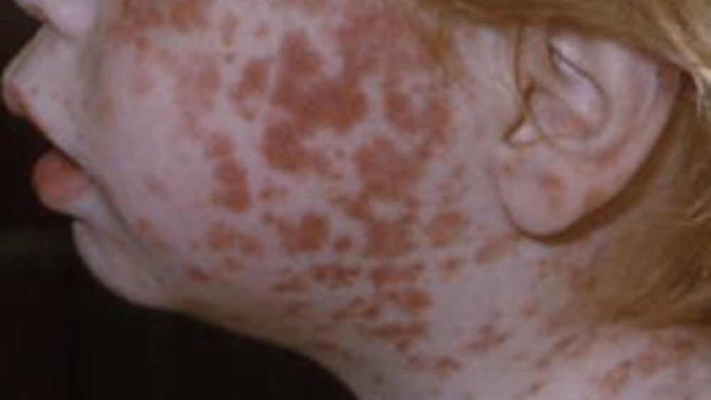 Measles: How it's caught, symptoms and treatment | ITV News Wales