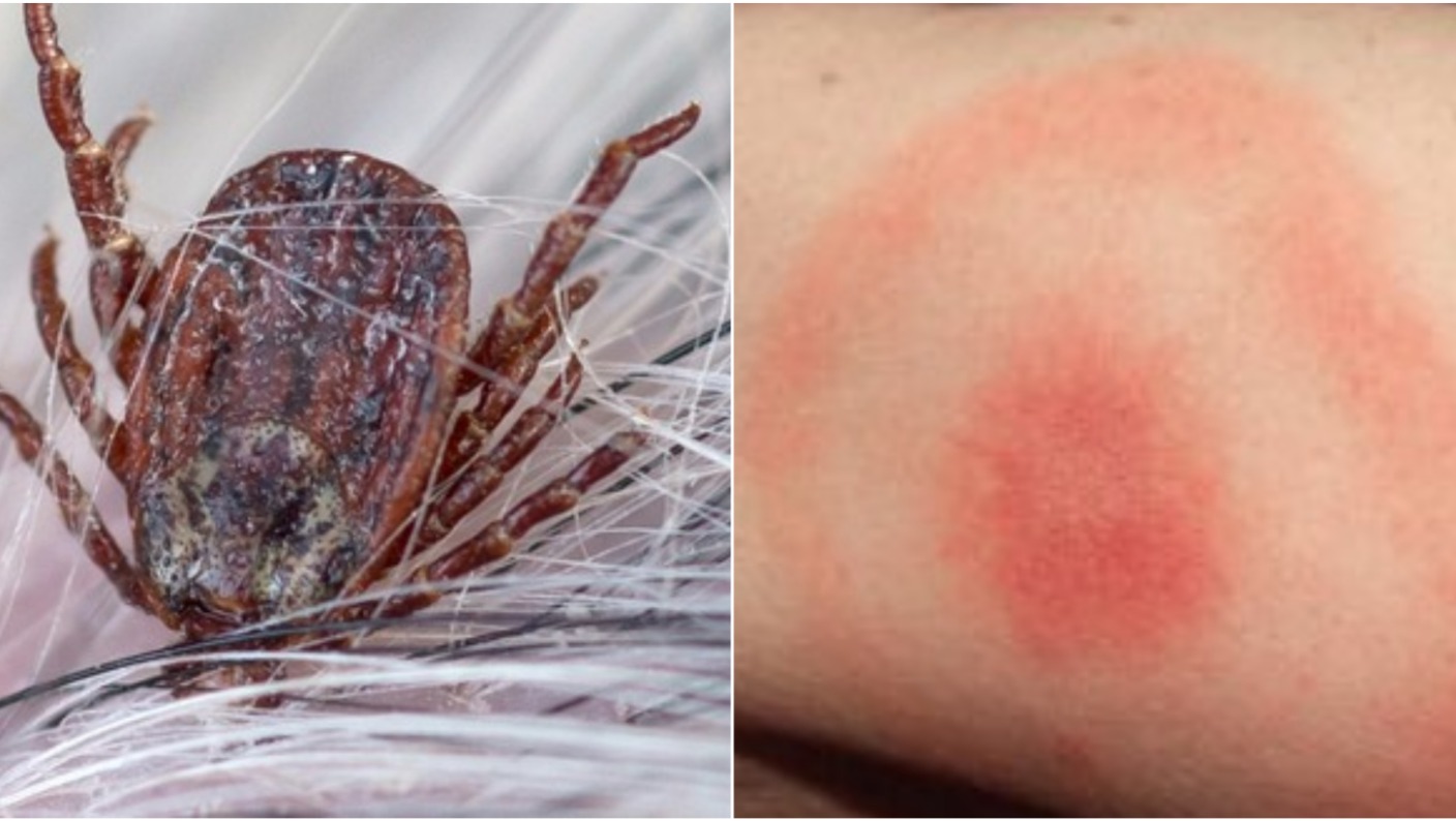 What is Lyme disease and what are the symptoms of the rapidly ...