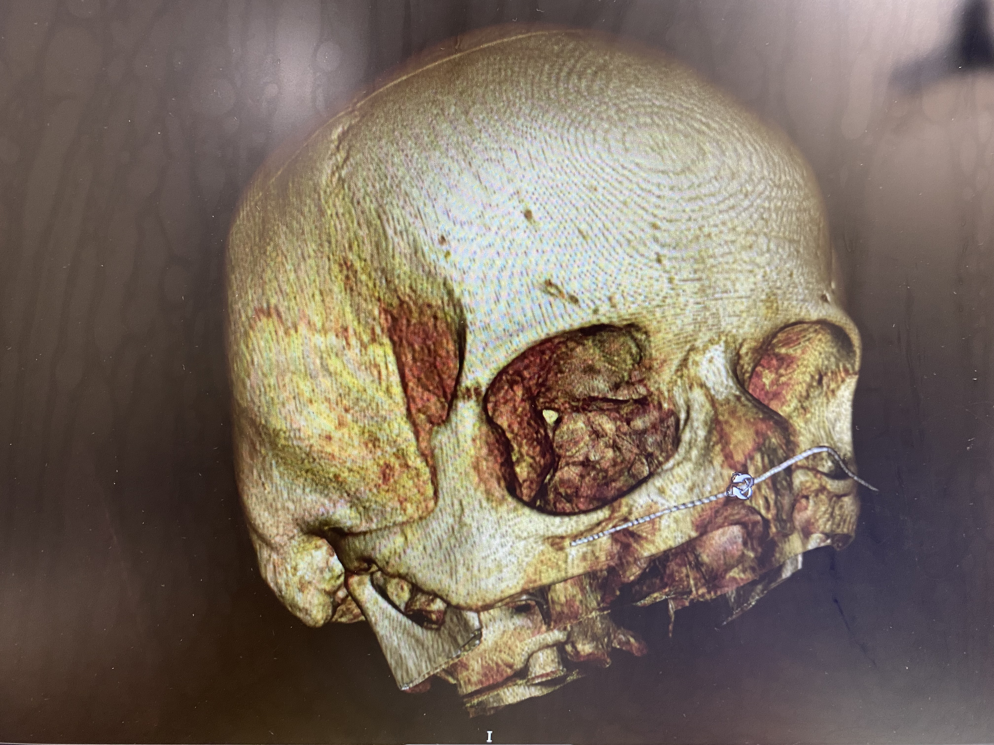 eye socket bone cancer
