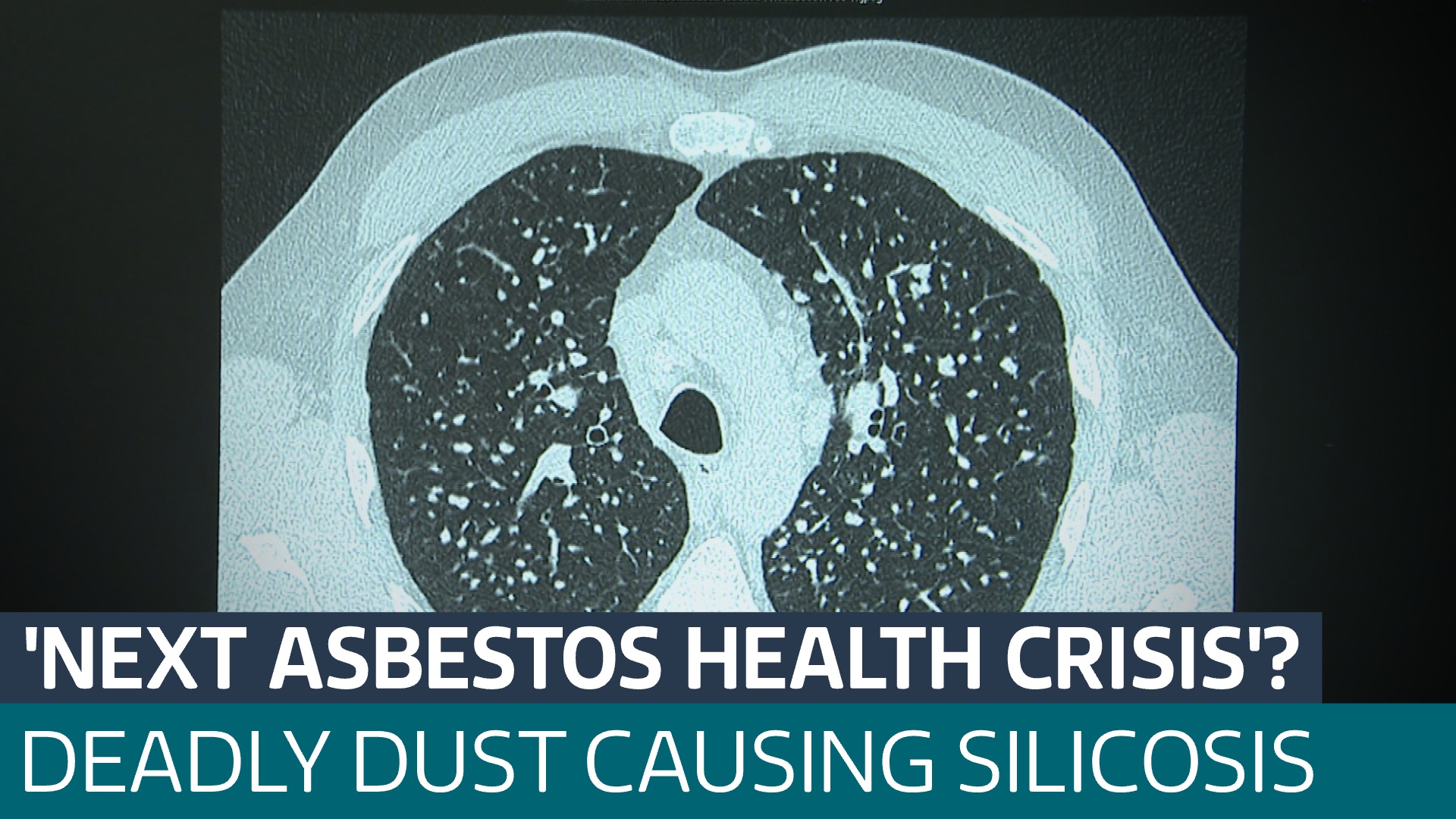 Rising cases of silicosis raise concerns for safety of Stonemasons ...