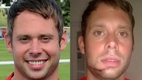 Warning Graphic Content: Footballer thanks medics after face "ripped ...