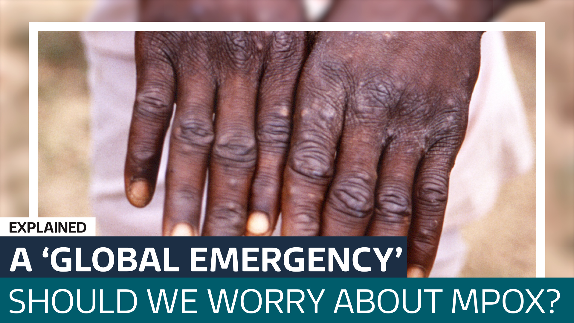 What is Mpox and how worried should we be? - Latest From ITV News