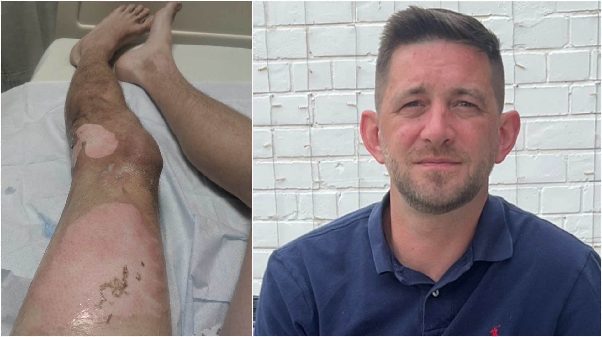 Man suffers third-degree burns after vape battery explodes in his ...