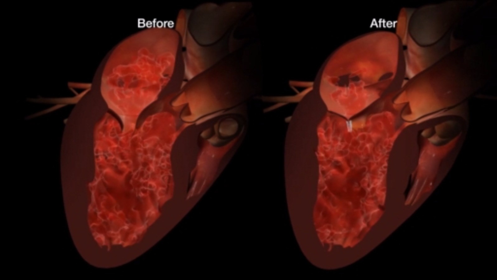 New heart procedure that could help save lives | ITV News West Country