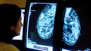 Warning Over unacceptable Postcode Lottery In Cancer Diagnosis