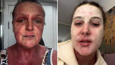 People left with burning skin turn to TikTok for help after NHS steroid ...