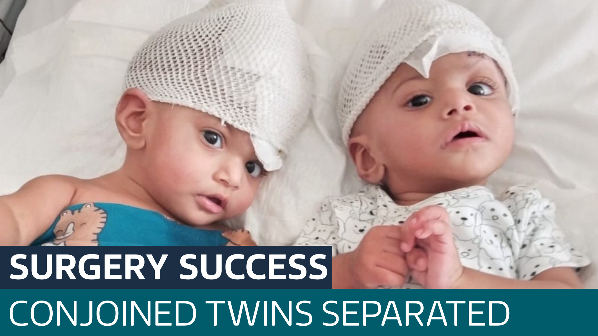 UK neurosurgeon leads first-of-its kind surgery to separate conjoined ...