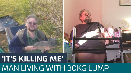 Man, 48, living with 30kg lump on abdomen fears it's 'killing' him ...
