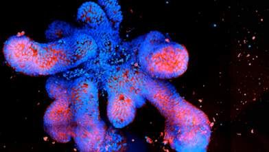 Researchers grow 'mini-human guts' to better understand Crohn's disease ...