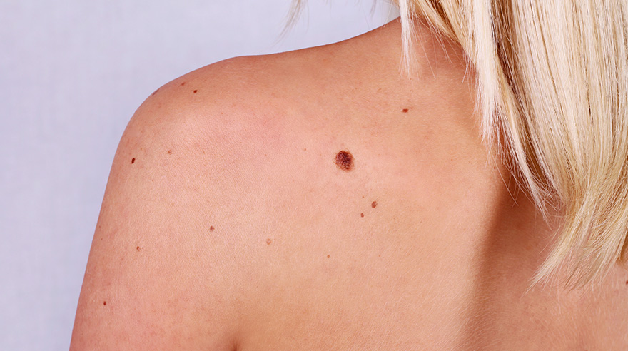 Skin Conditions Worth Watching | Sharp HealthCare