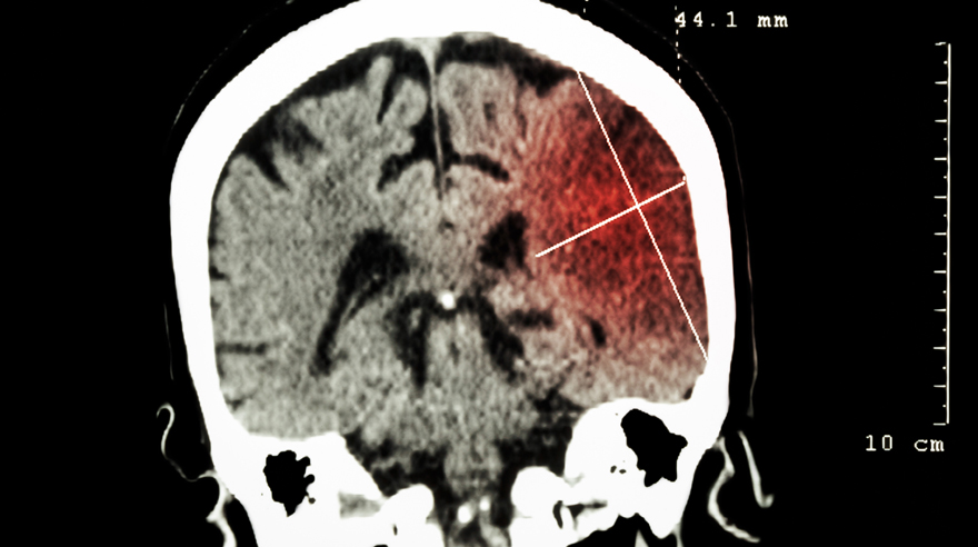 Anatomy of a Stroke | Sharp HealthCare