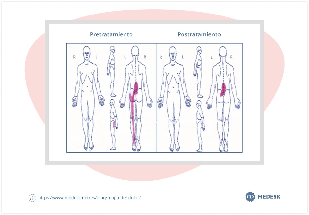 Mapa De Dolor Importancia Contenido Y Formatos En Fisioterapia