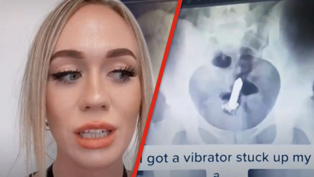 Woman gets surgery after accidentally getting a vibrator stuck in her ...
