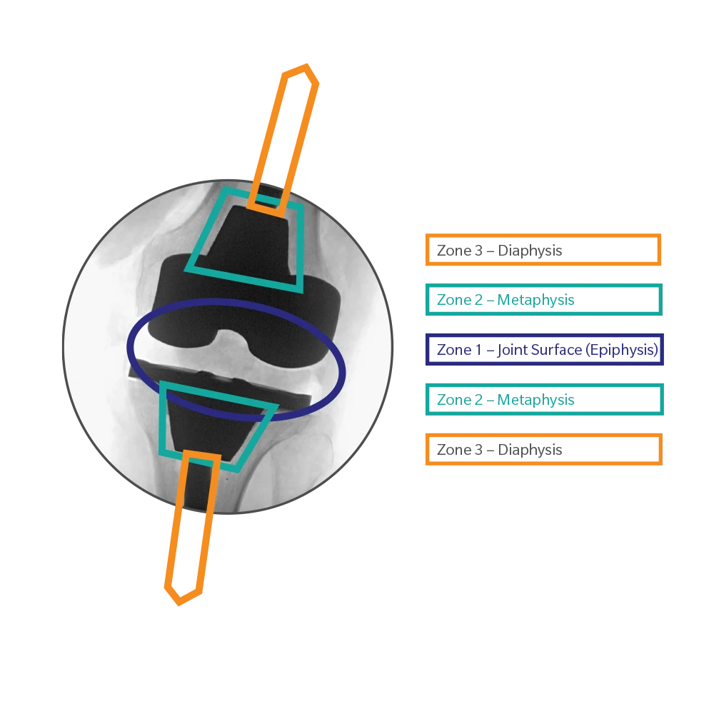 Persona® Revision Knee | Zimmer Biomet | Zimmer Biomet