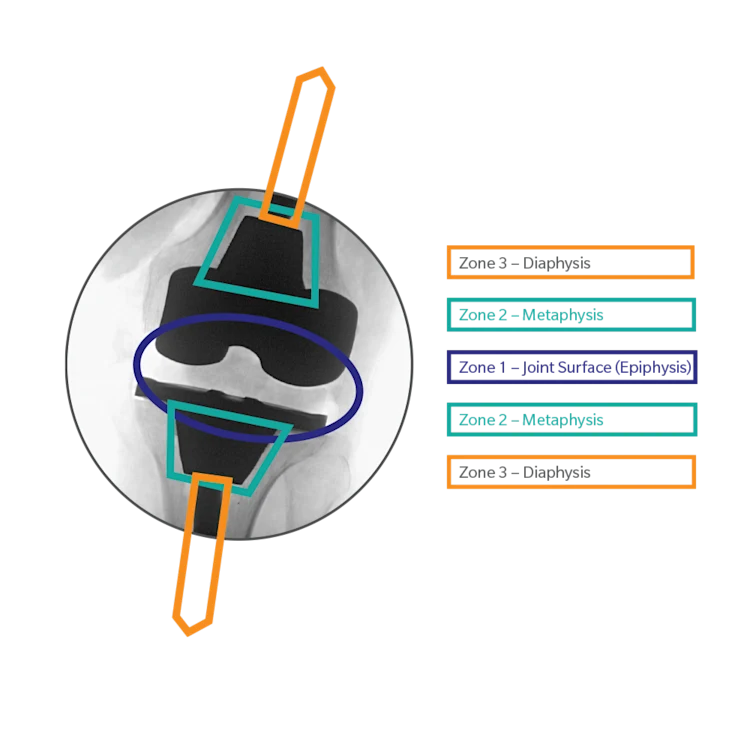 Persona® Revision Knee | Zimmer Biomet | Zimmer Biomet