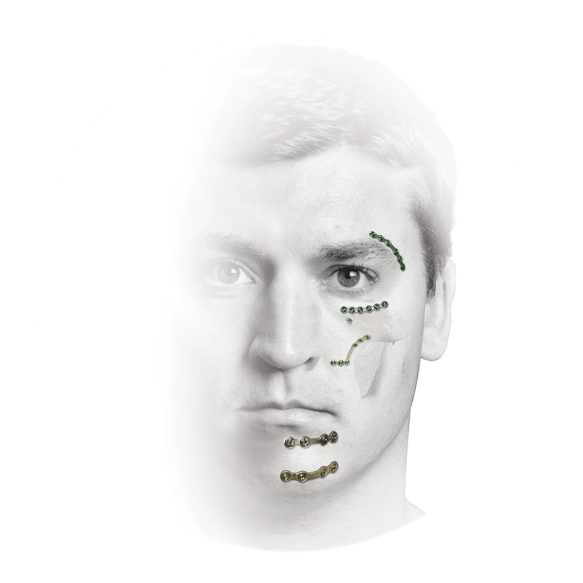 CMF: Trauma and Reconstruction | Zimmer Biomet