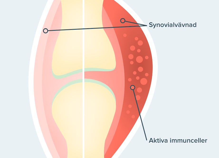 Vad är en autoimmun sjukdom? - Elsa
