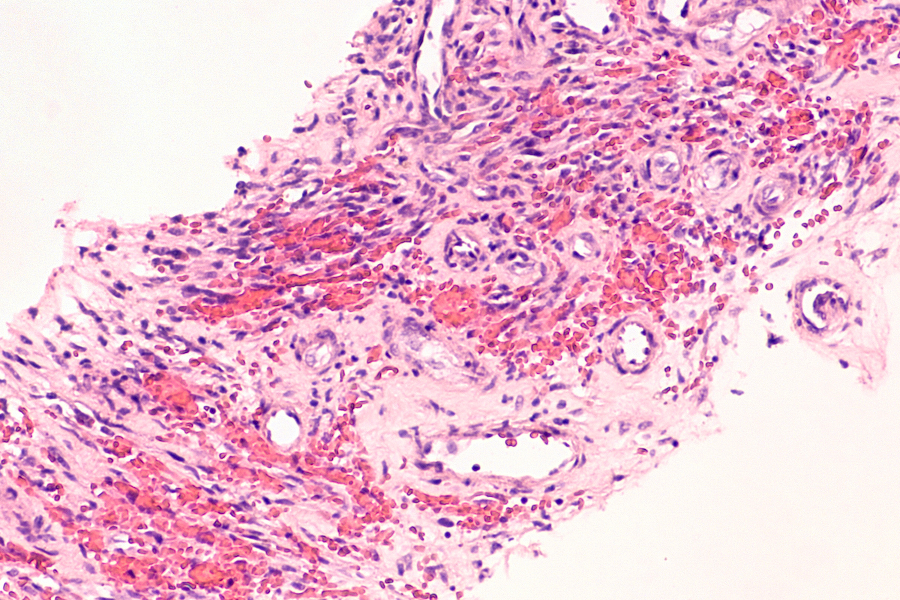 What Is the Link Between HIV and Kaposi Sarcoma?