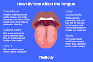 What Do Hiv Tongue Sores Look Like Infoupdate What Do Hiv Tongue Sores Look Like Infoupdate