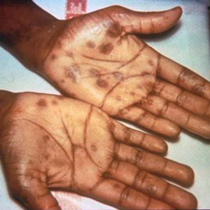 Basic Questions and Answers About Syphilis