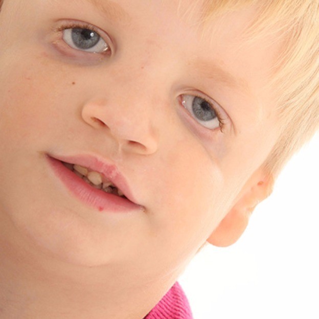 'My facial deformity led to bullying - now it's the subject of a ...