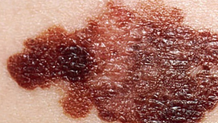 MOLE CLINIC: One check that could save your life | This Morning