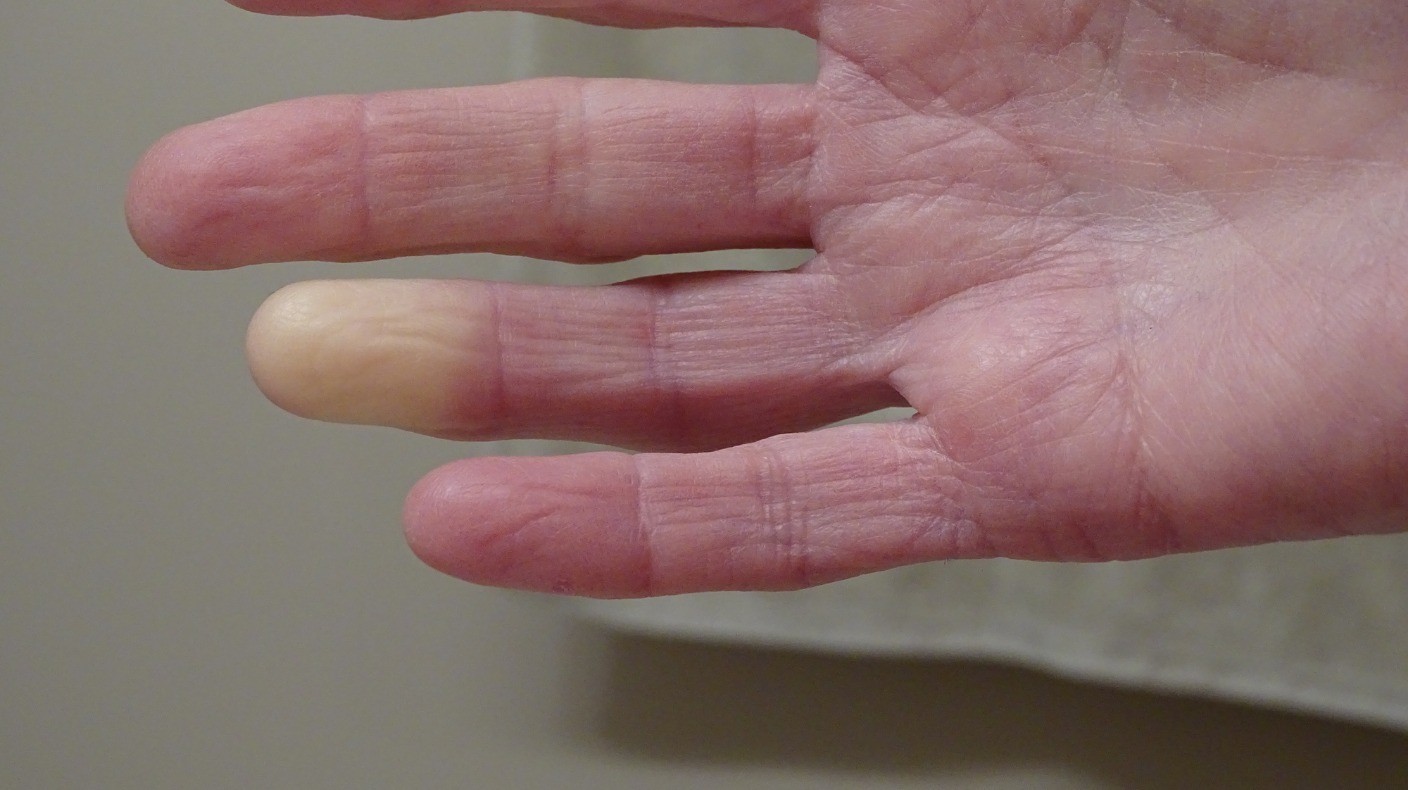 What is Raynaud's phenomenon? | This Morning