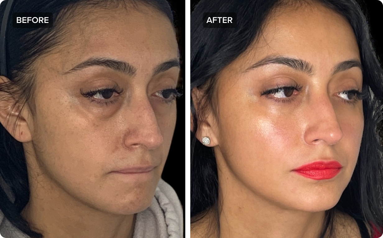 Fat Injections Cheeks