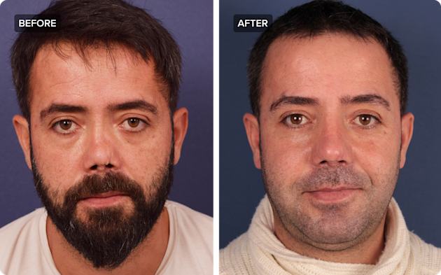 Revision Rhinoplasty Surgery, Results, Recovery, Pros & Cons | RealSelf