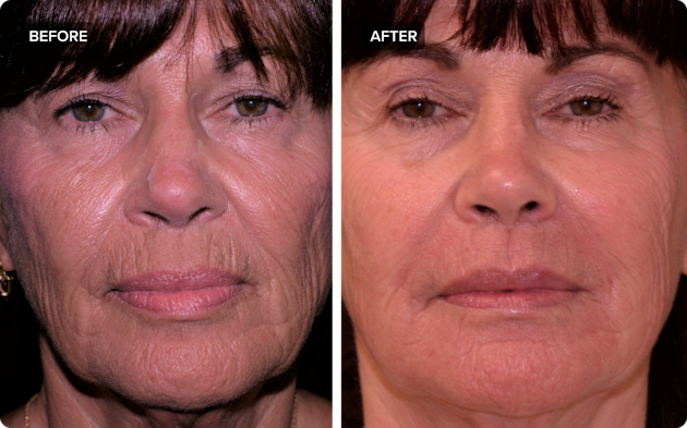 Fat Transfer to Face Procedure & How Long Results Last