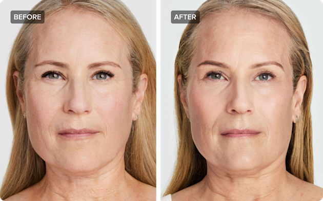 Does Ultherapy Work, and How Long Does It Last? - RealSelf