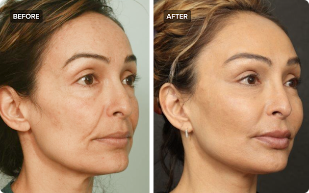 Mini Facelift: What It Is, Risks & How Long It Lasts - RealSelf