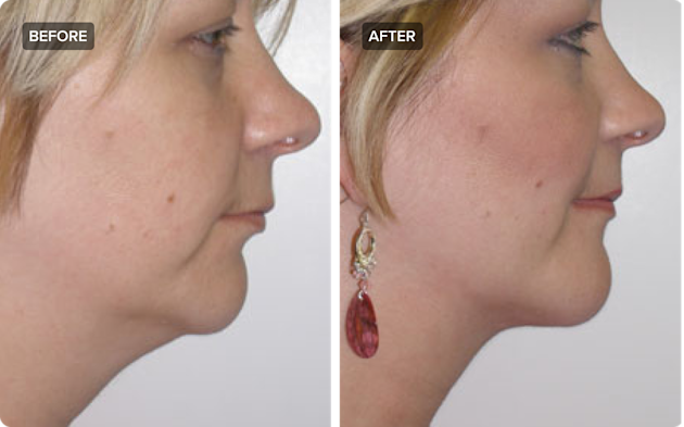 Double Chin Lipo: How It's Done, Recovery, Results & More