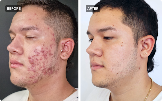 CO2 Laser Skin Resurfacing | RealSelf