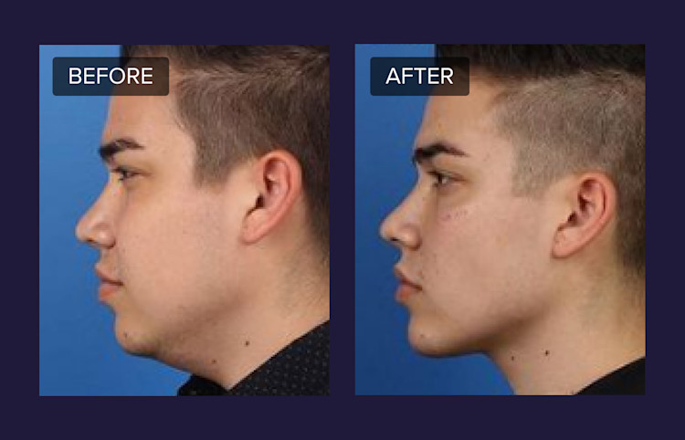 What Is Kybella? Swelling, Side Effects, Results | RealSelf