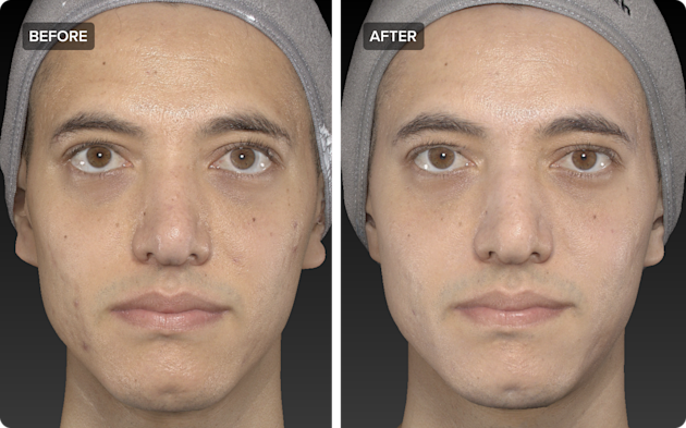 Is Microneedling Worth It? Benefits, Pain Level & Side Effects - RealSelf