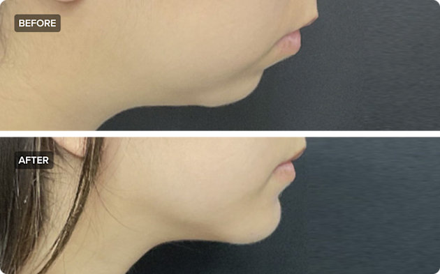 Genioplasty Chin Surgery vs. a Chin Implant | RealSelf
