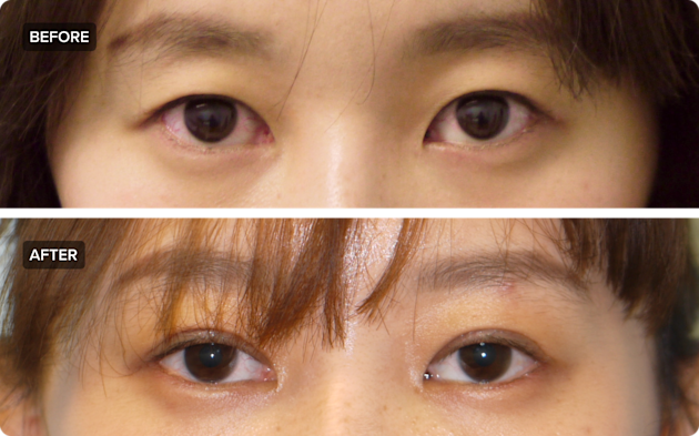 Double Eyelid Surgery: How Asian Blepharoplasty Works | RealSelf