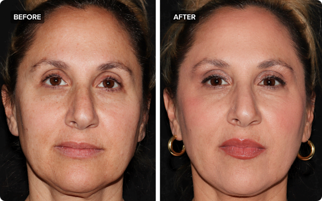 How Does Sofwave Wrinkle Treatment Work? - RealSelf