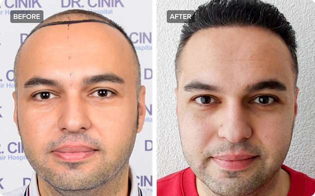 FUE Hair Transplant: Doctors Explain Follicular Unit Extraction - RealSelf